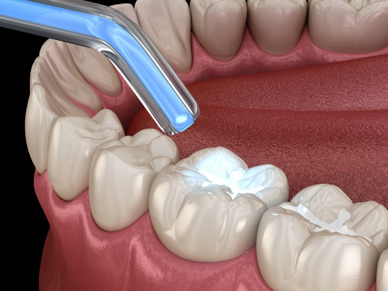 Diagnosing Tooth Decay With DIAGNOdent | Livonia, MI