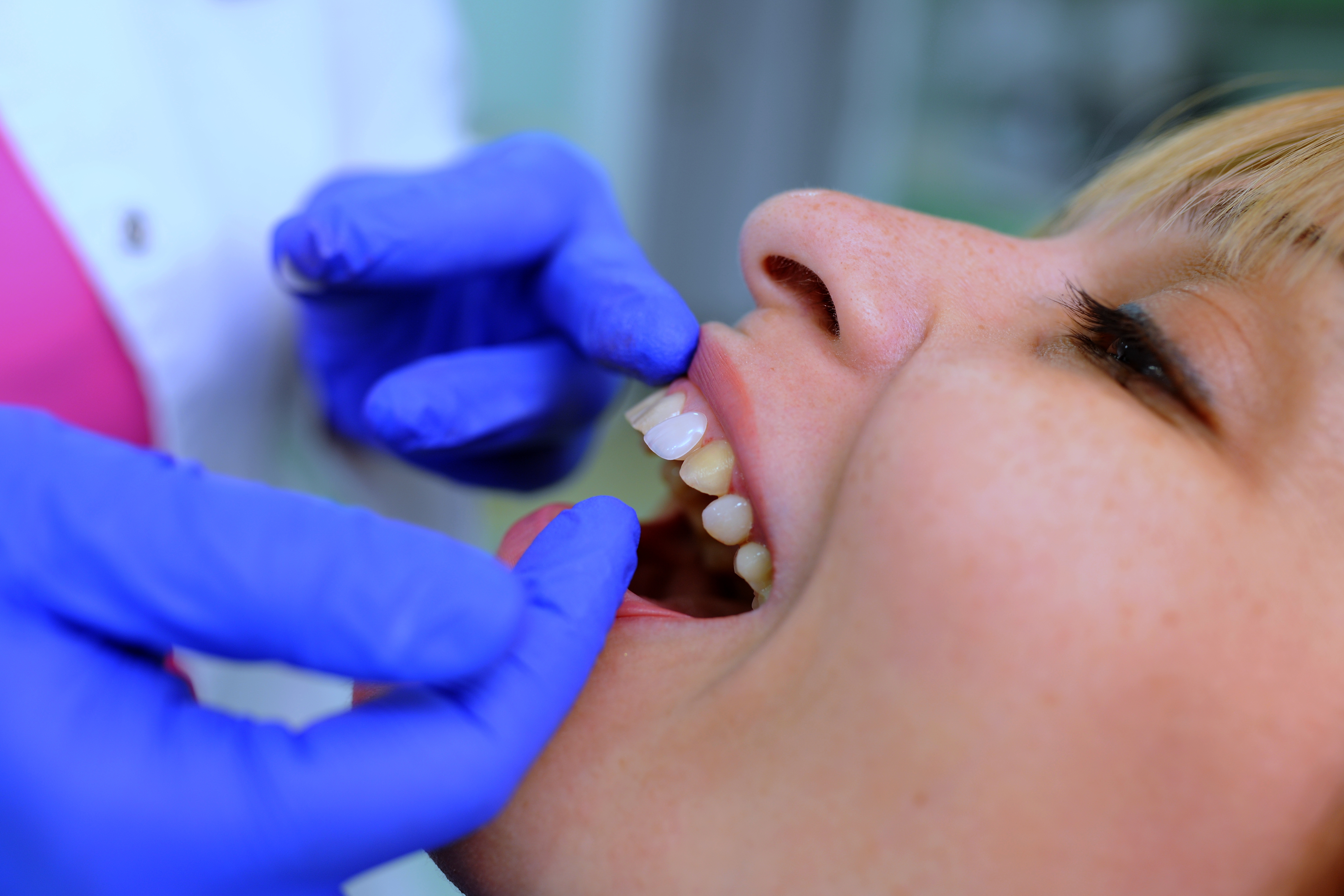 Offering A Dazzling Smile With Custom Veneers | Livonia, MI
